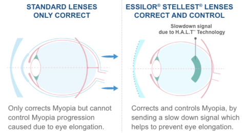 Why Offer Children Myopia Control Lenses - Kodak Lens Vision Centre