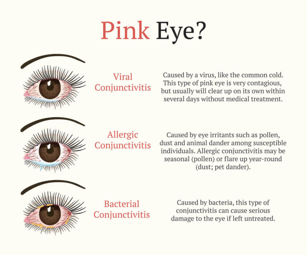 Eye Allergies vs. Allergic Conjunctivitis vs. Pink Eye: What's the ...